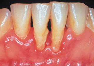 examen parcial: PERIODONCIA DIAPOSITIVAS